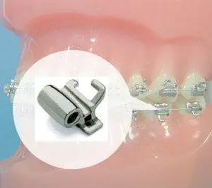 Parts Of Braces | Ricci Orthodontics