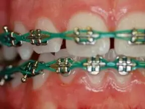 Parts Of Braces | Ricci Orthodontics